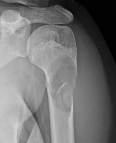 Unicameral Bone Cyst | The Bone School